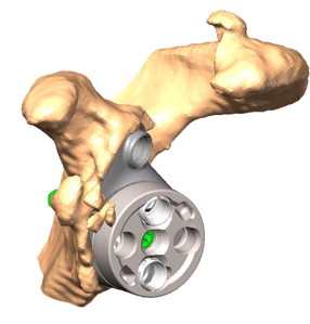 ALM Ortho, a Patient Matched Device Solutions Company